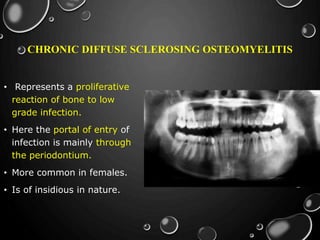 Focal Sclerosing Osteomyelitis