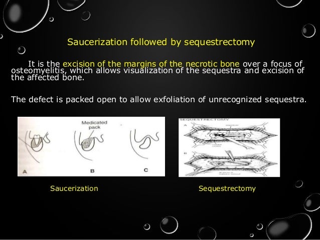 Saucerization
