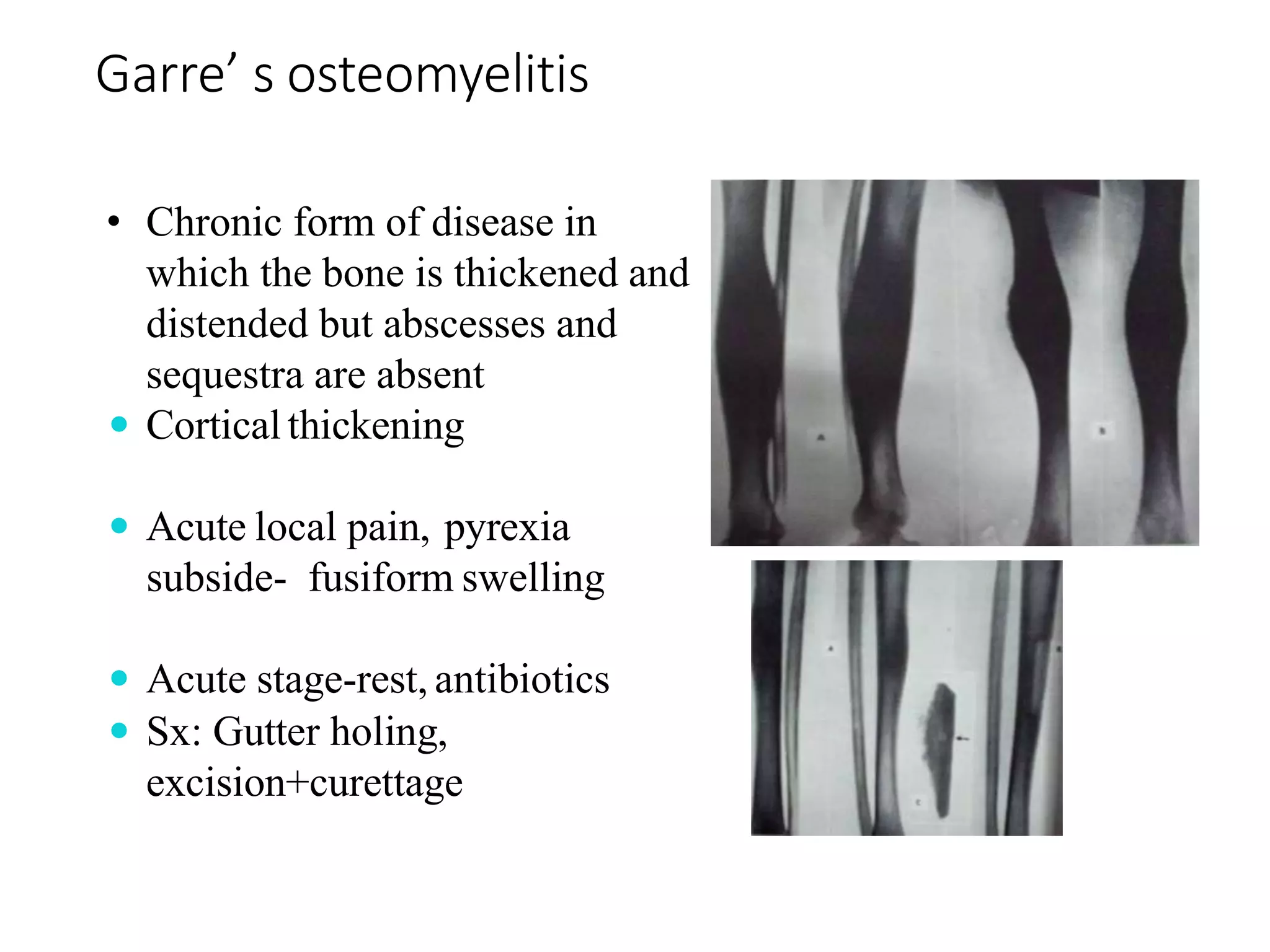 Osteomyelitis | PPTX
