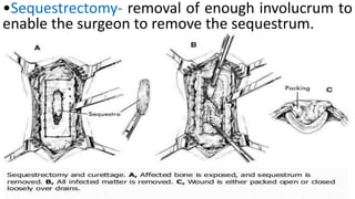 Osteomyelitis and its management | PPTX