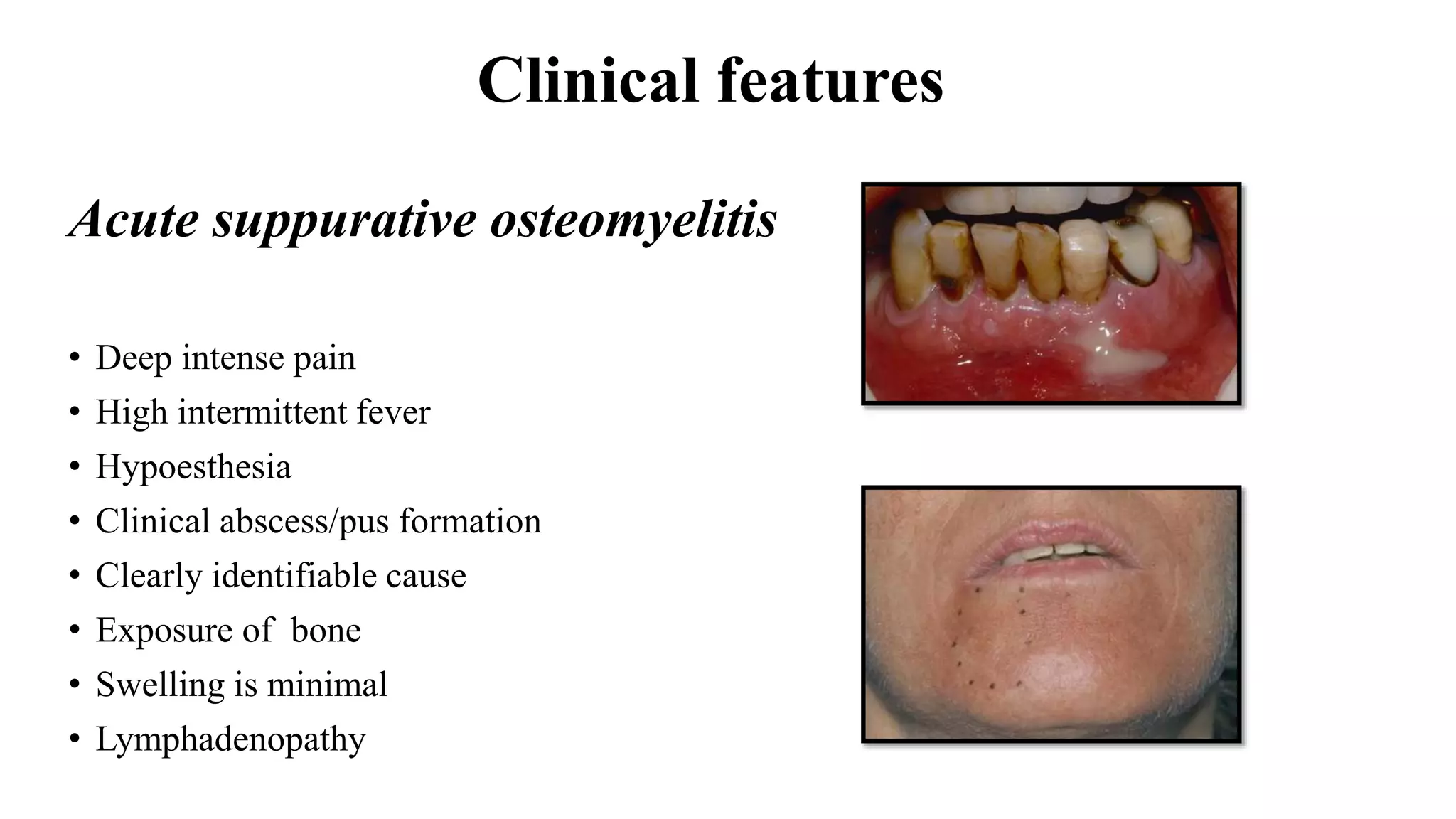 Osteomyelitis of facial skeleton | PPTX