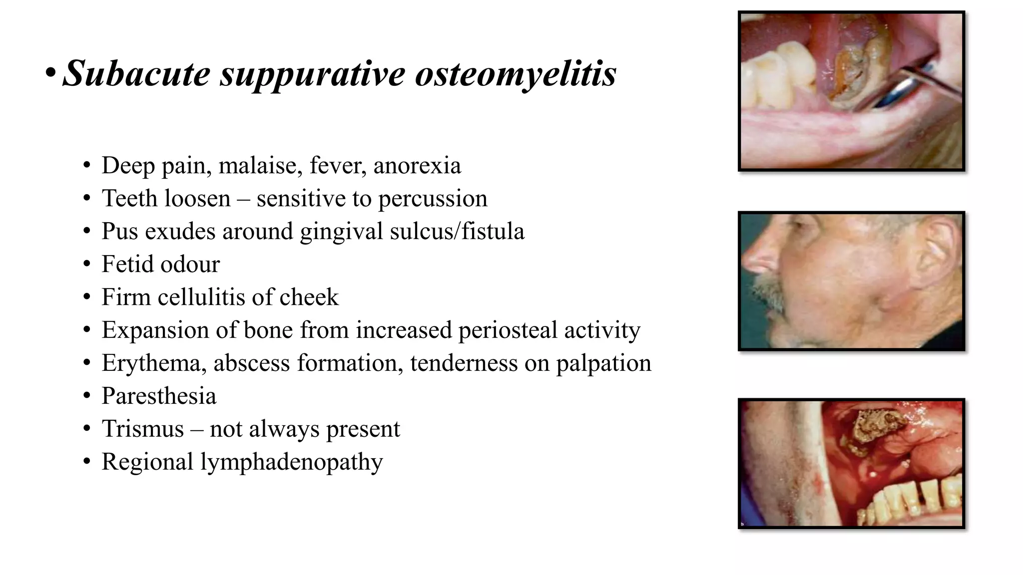 Osteomyelitis of facial skeleton | PPTX