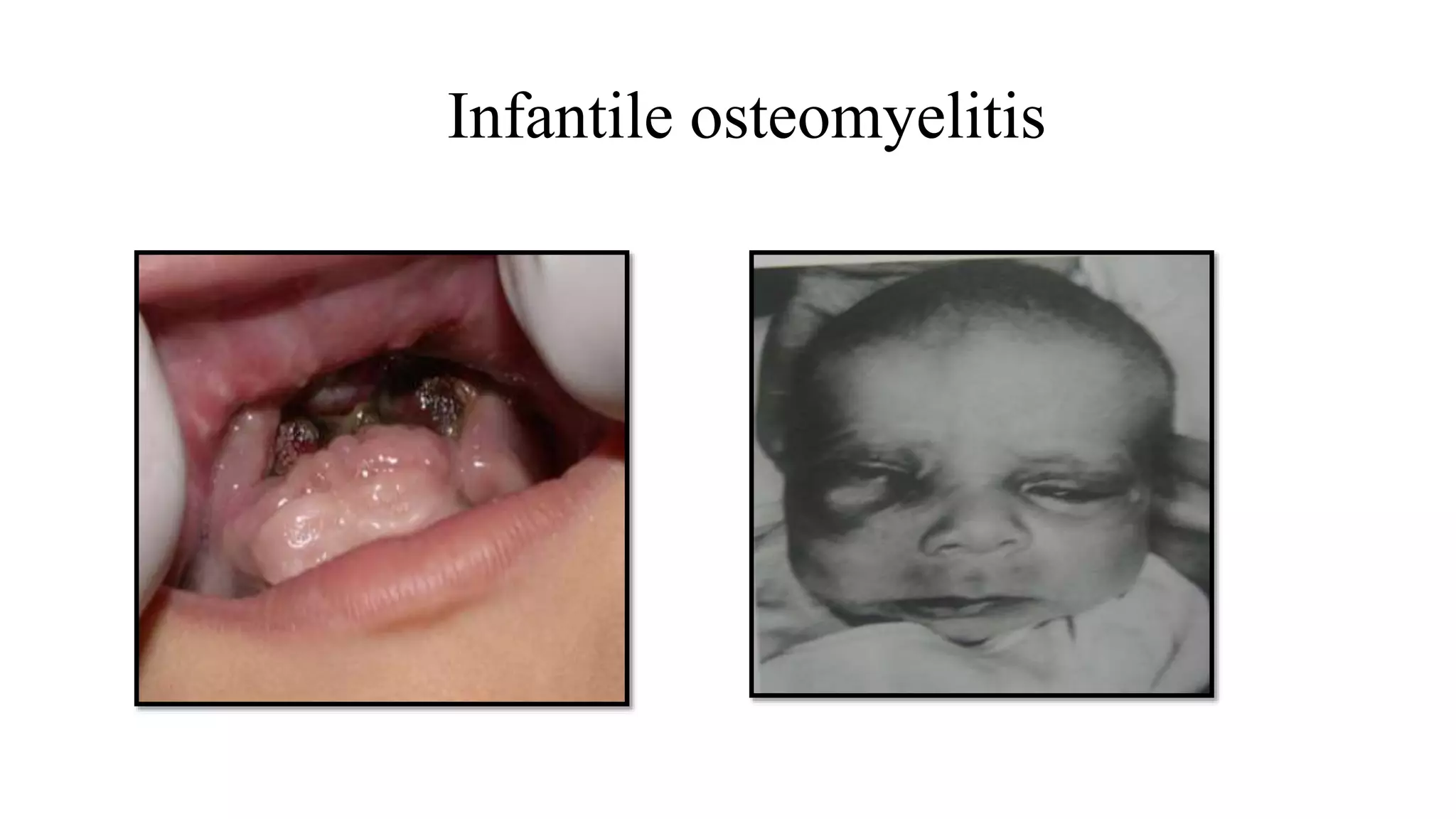 Osteomyelitis of facial skeleton | PPTX