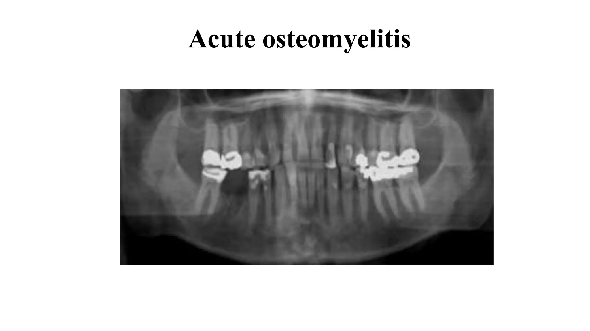 Osteomyelitis of facial skeleton | PPTX