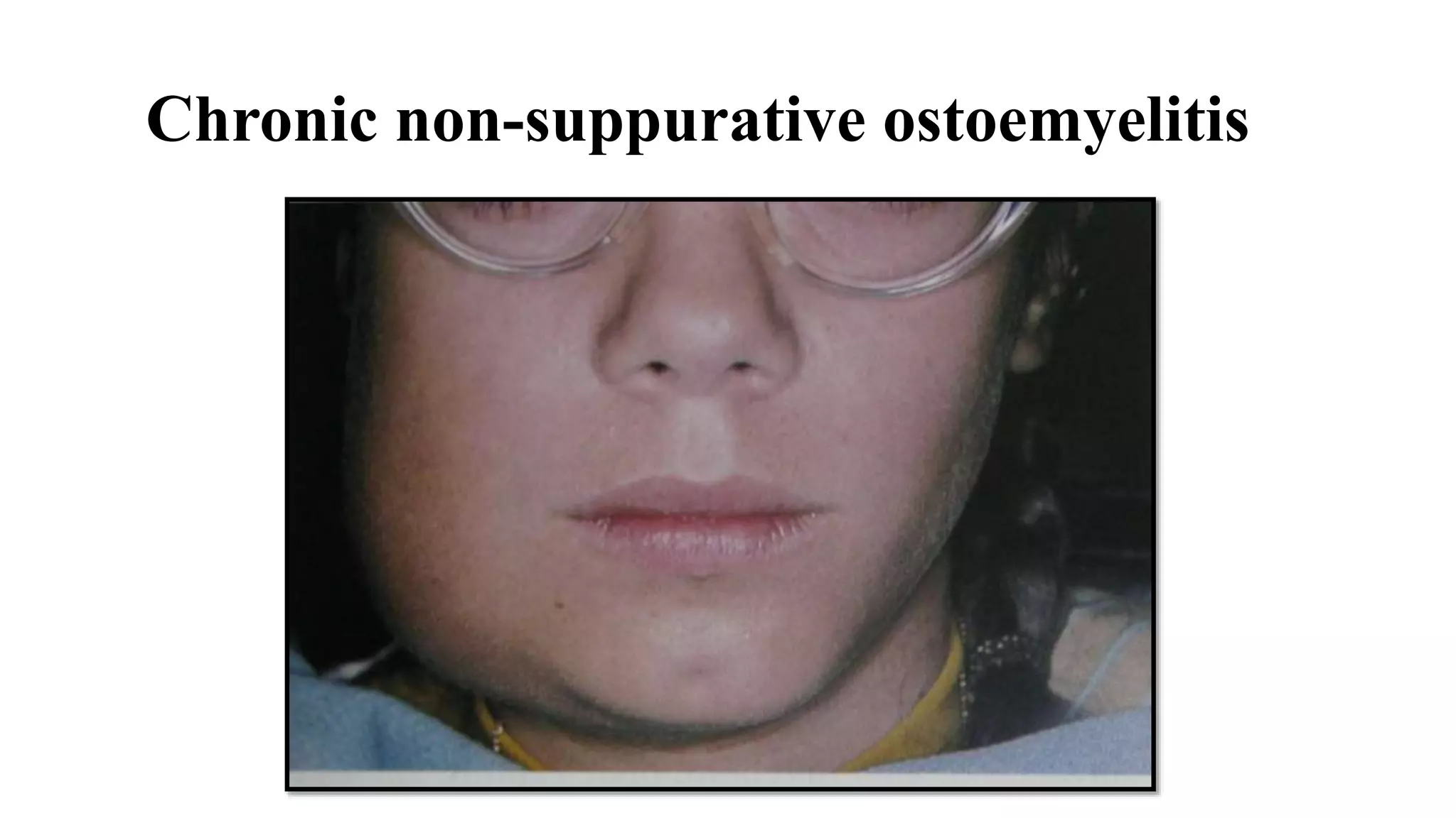 Osteomyelitis of facial skeleton | PPTX