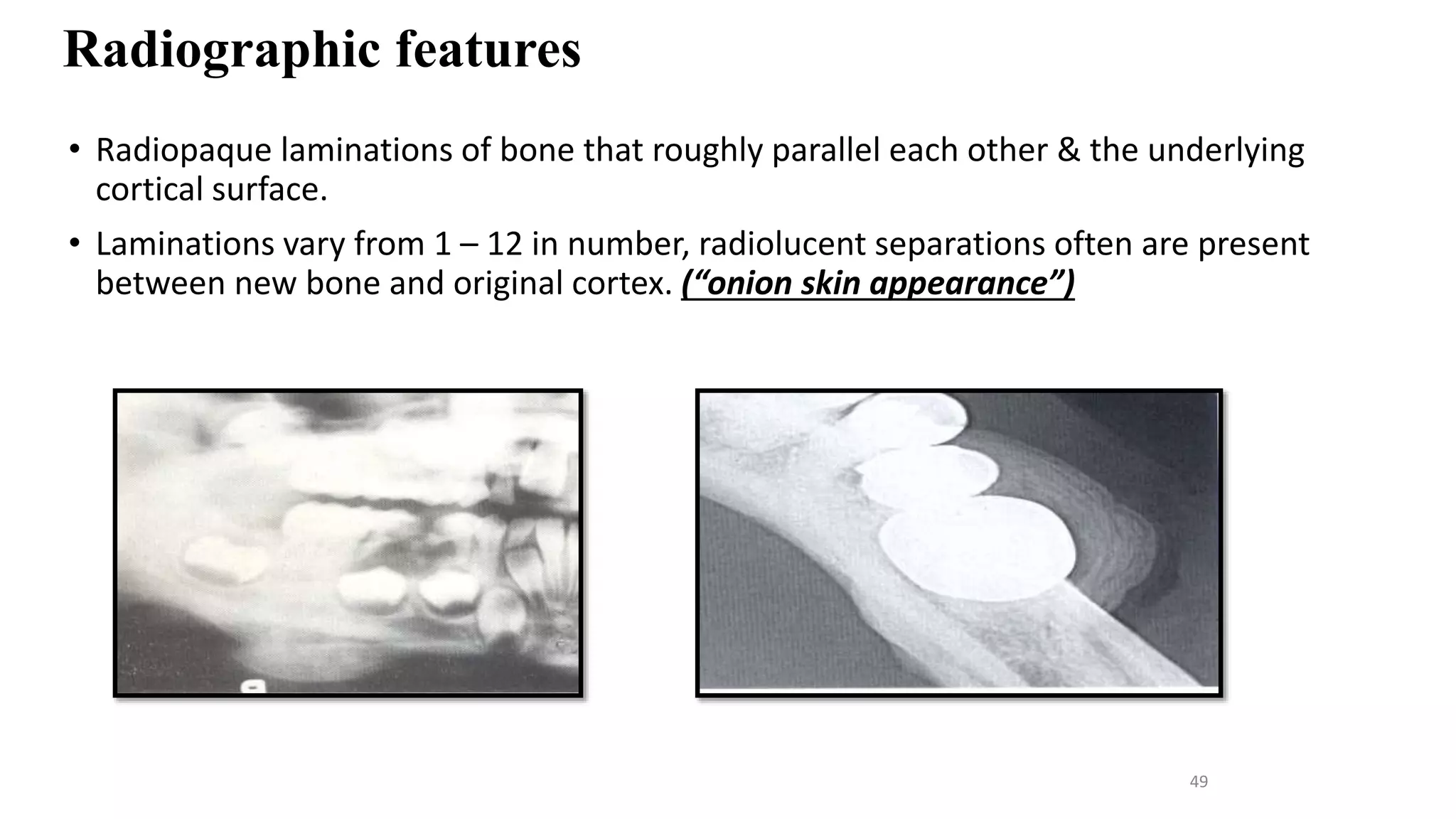 Osteomyelitis of facial skeleton | PPTX