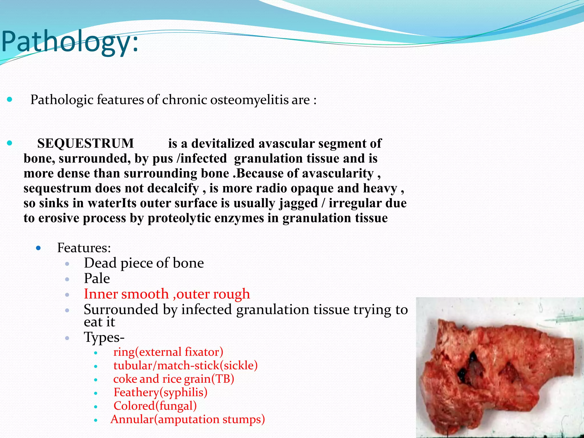 Osteomyelitis | PPTX