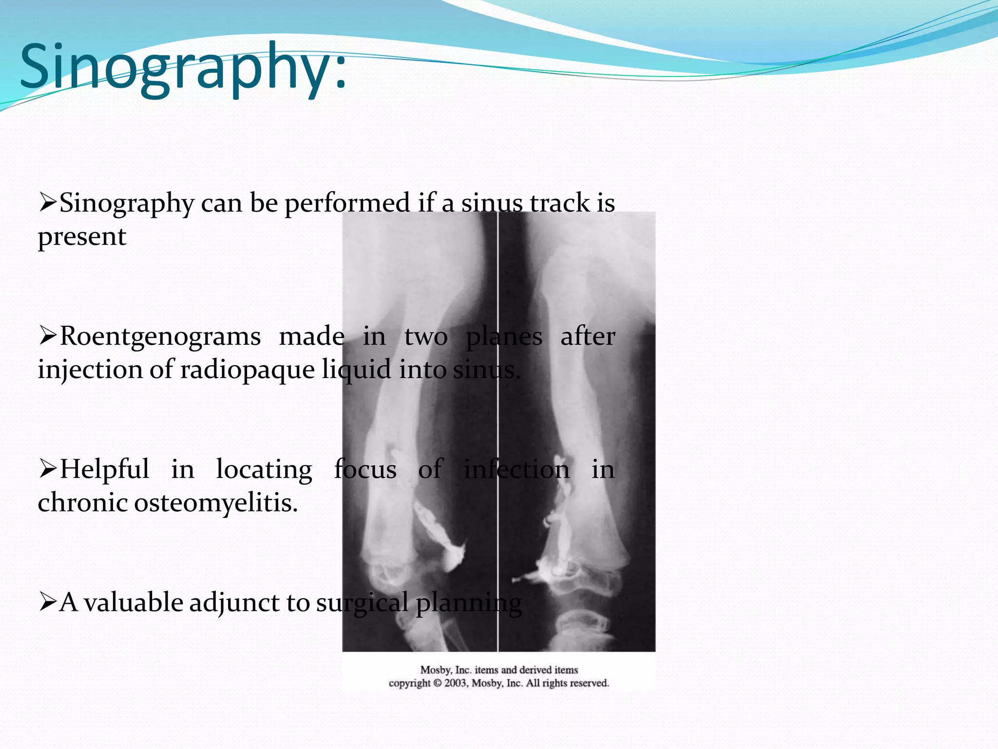 Osteomyelitis | PPT