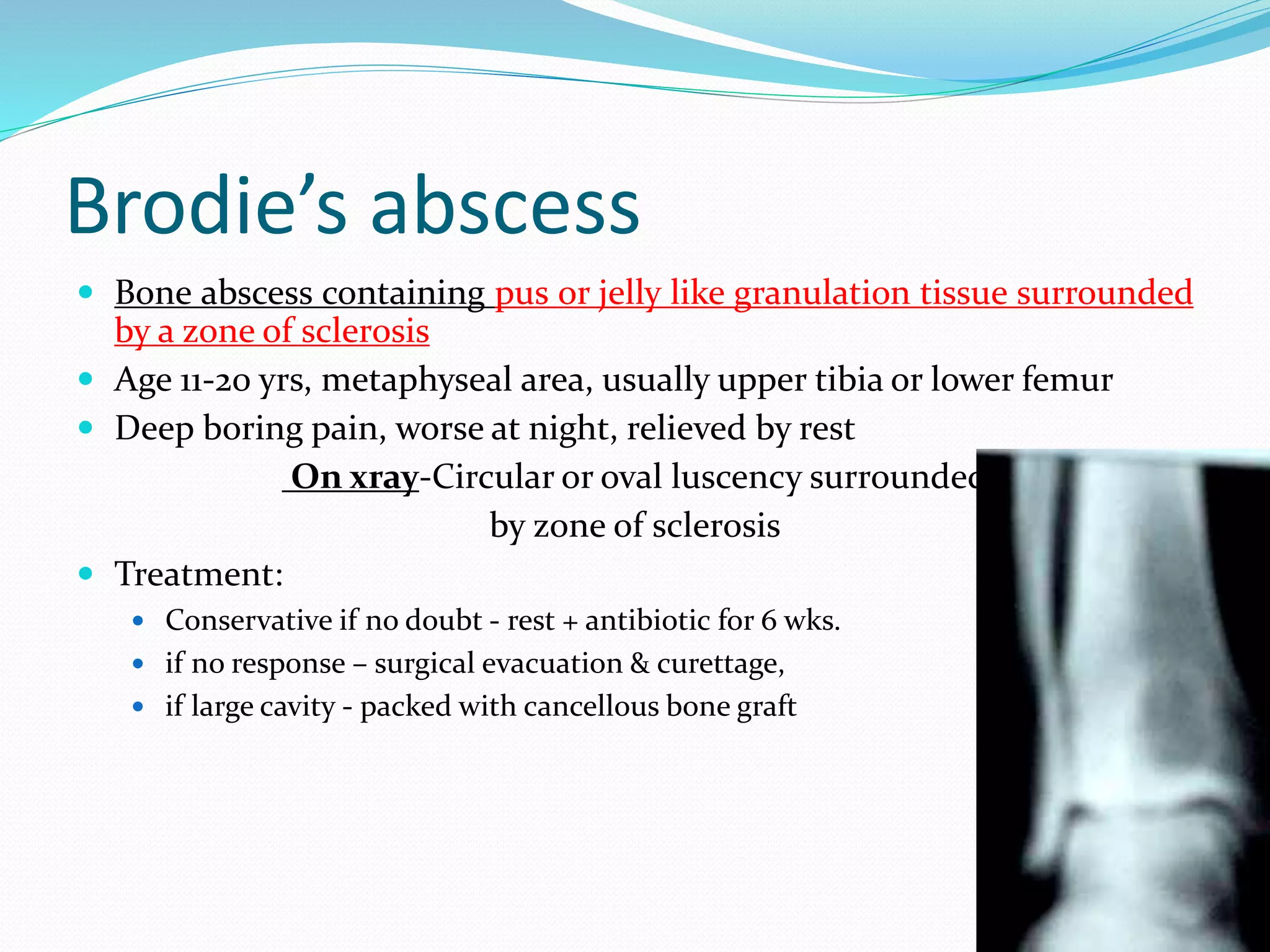 Osteomyelitis | PPTX