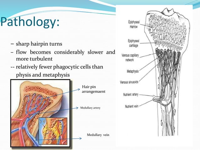 Osteomyelitis | PPT