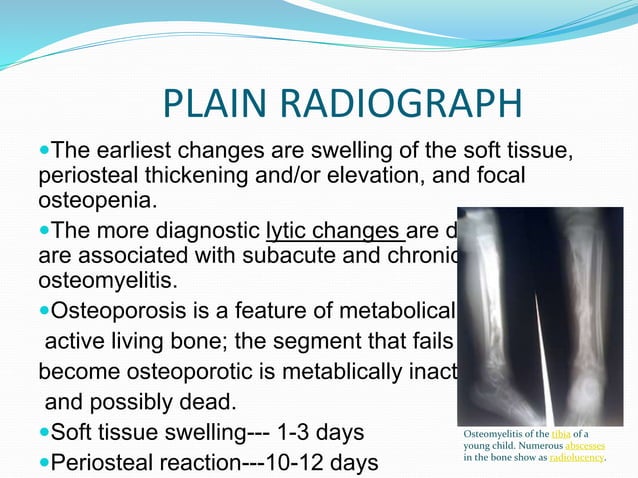 Osteomyelitis | PPT