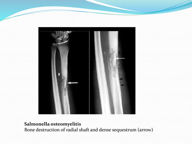 Osteomyelitis | PPT