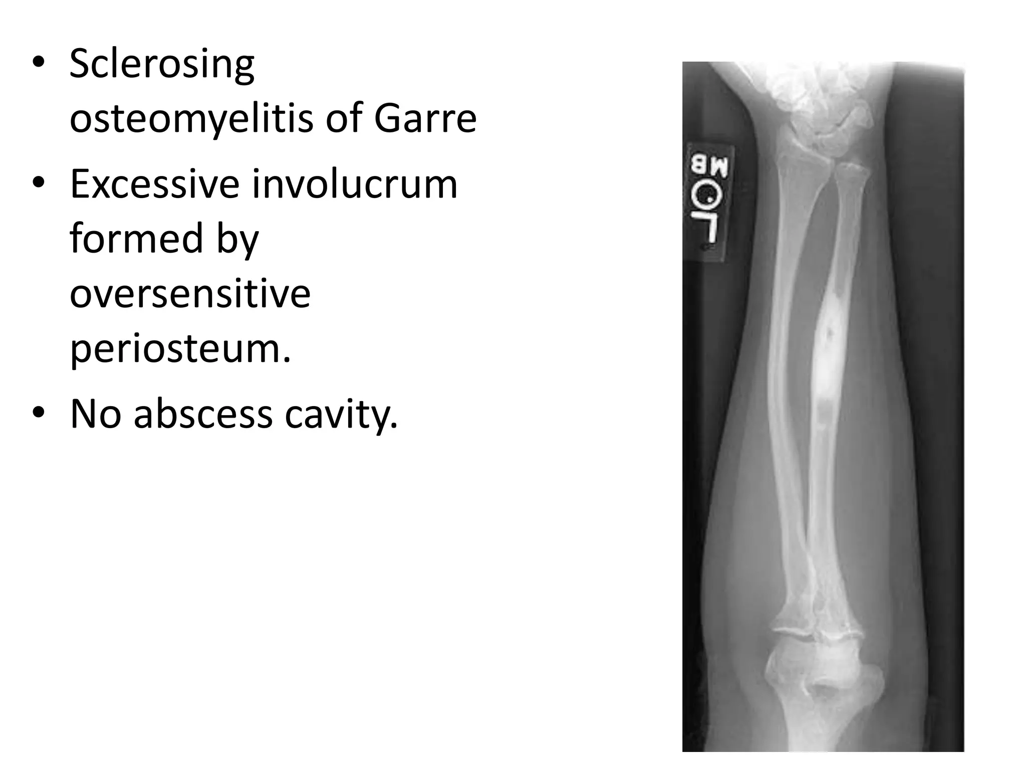 Osteomyelitis | PPTX