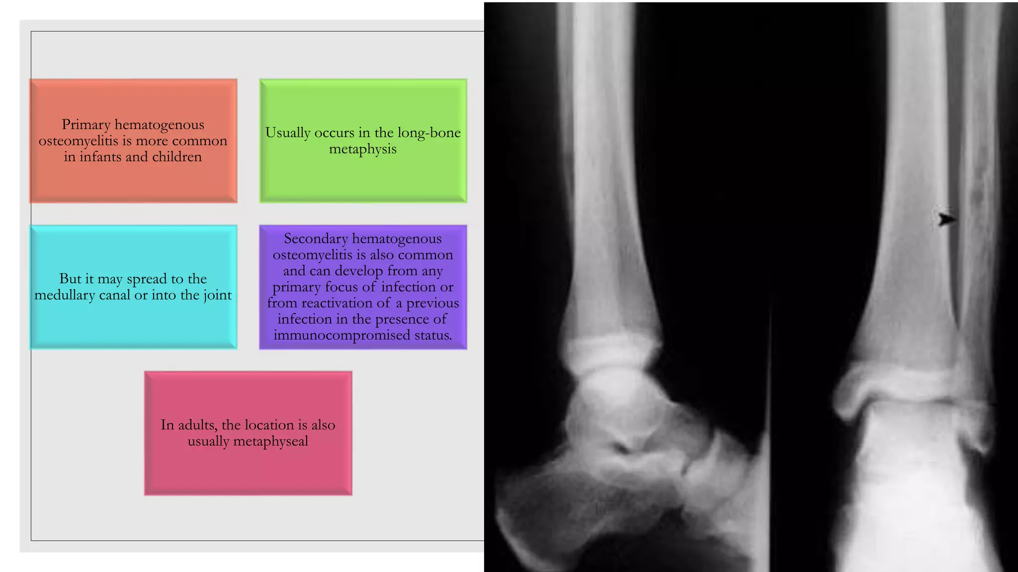 osteomyelitis.pptx