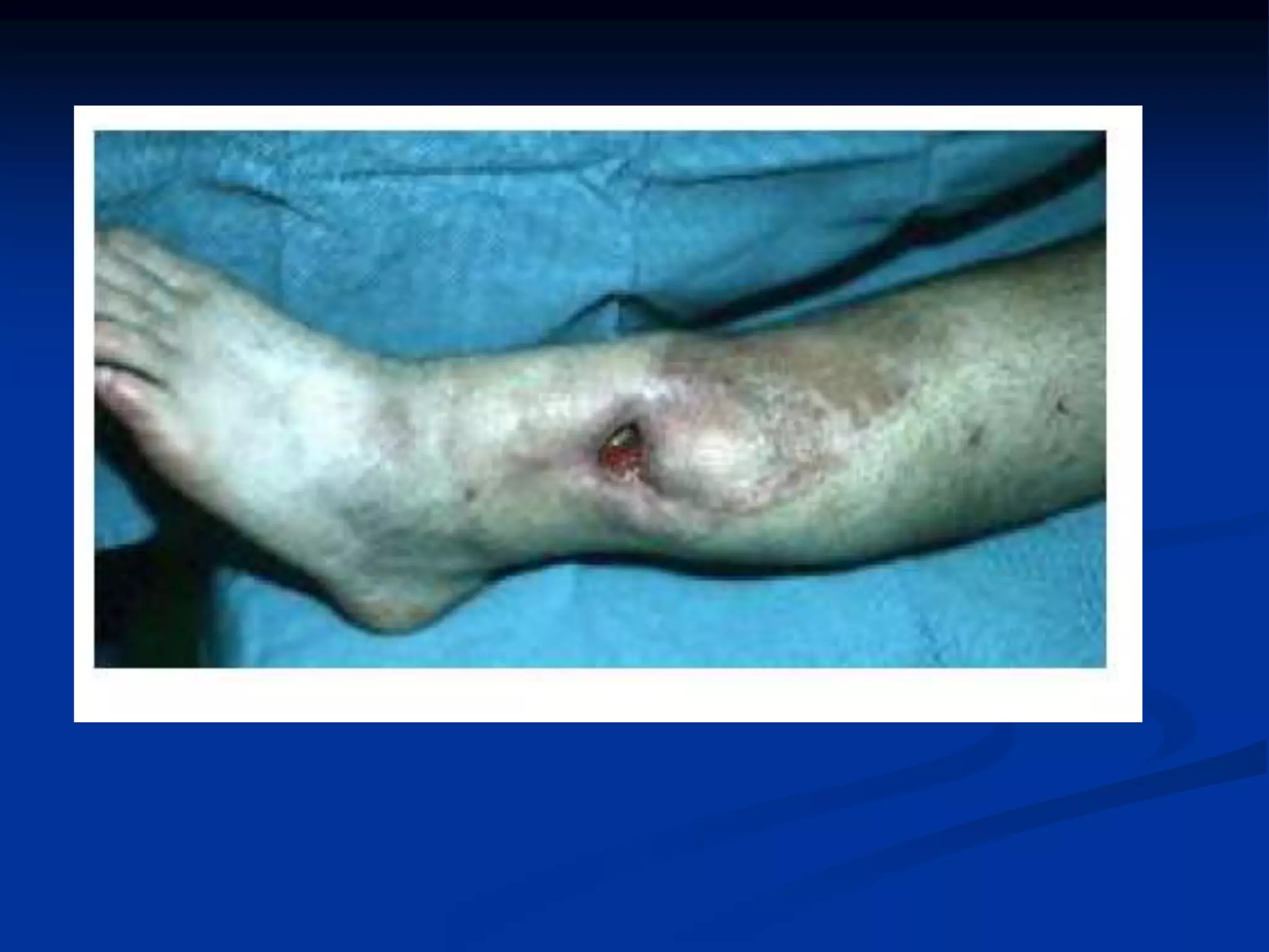 Osteomyelitis.ppt