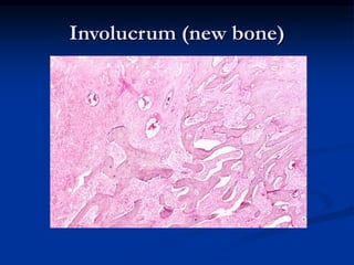 Osteomyelitis.ppt