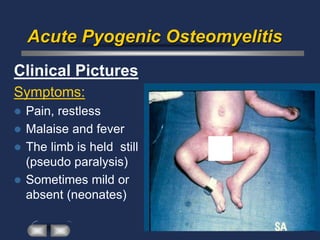 osteomyelitis.pptx