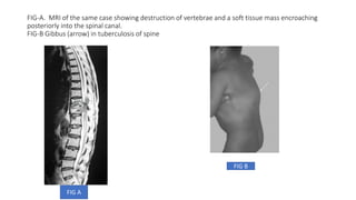 OSTEOMYELITIS.pptx