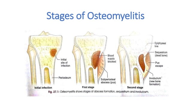 OSTEOMYELITIS.pptx