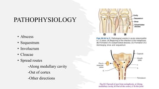 Osteomyelitis.pptx