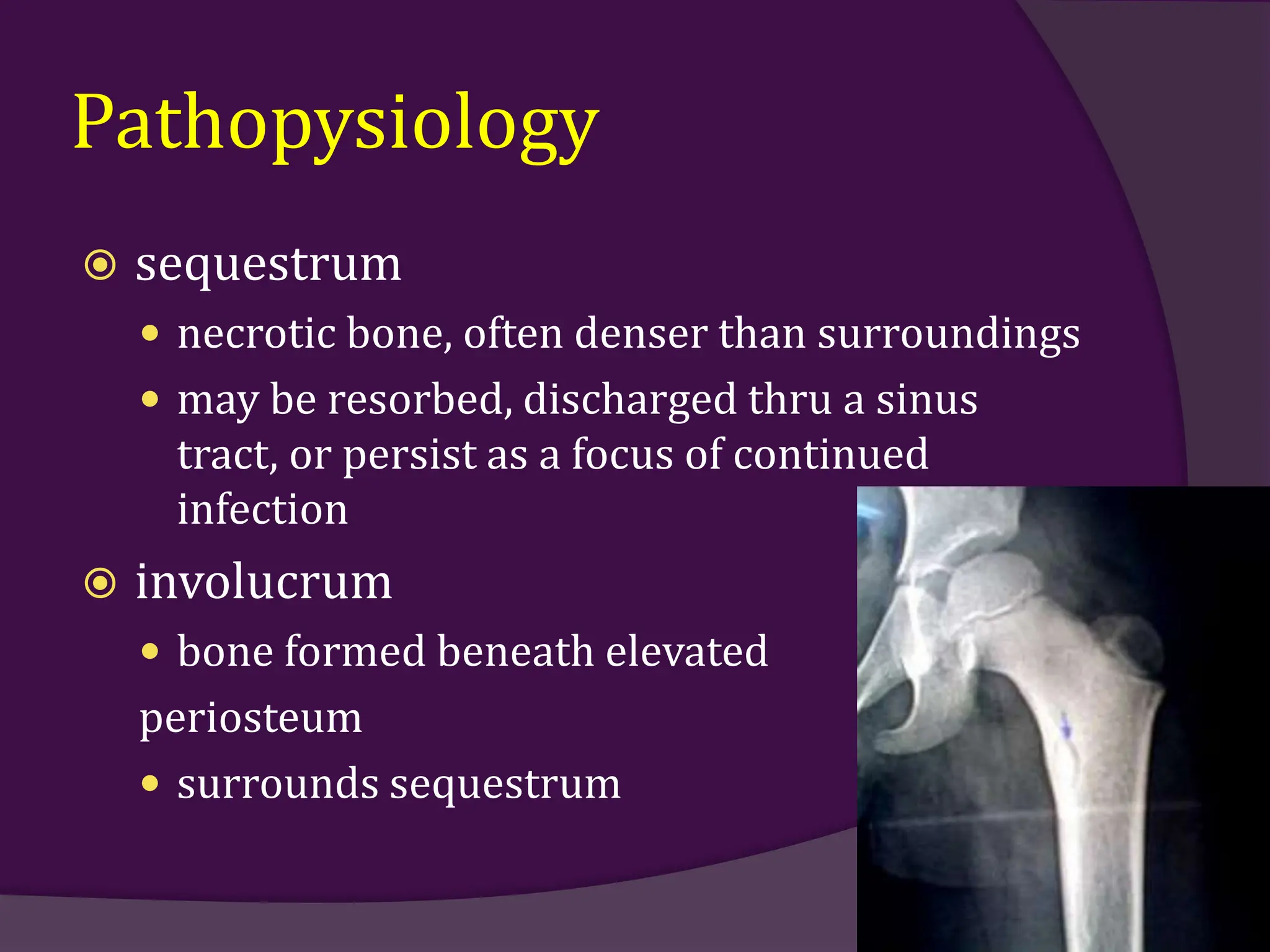osteomyelitis.ppt