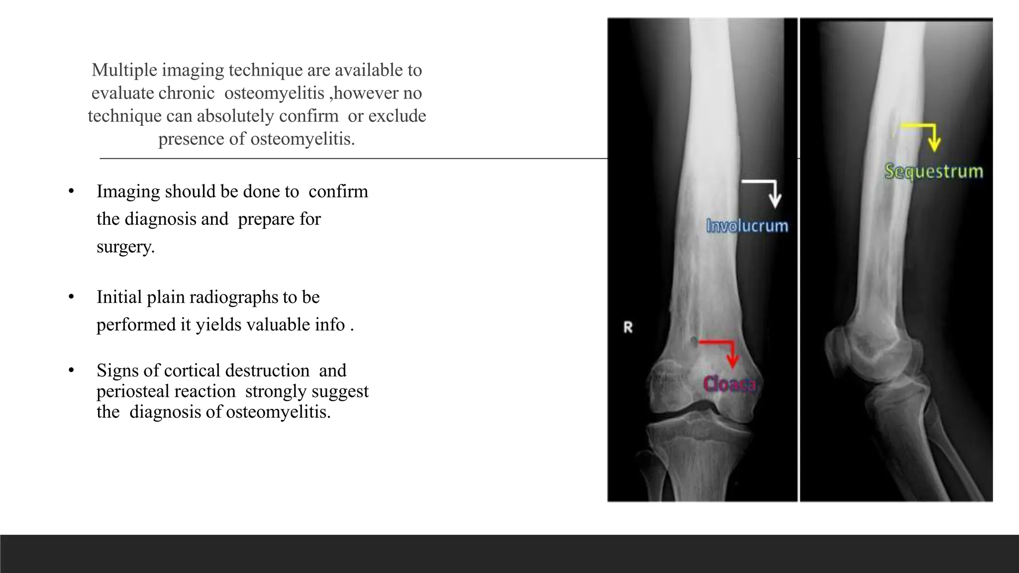 Chronic Osteomyelitis, Bone infection slides | PPTX
