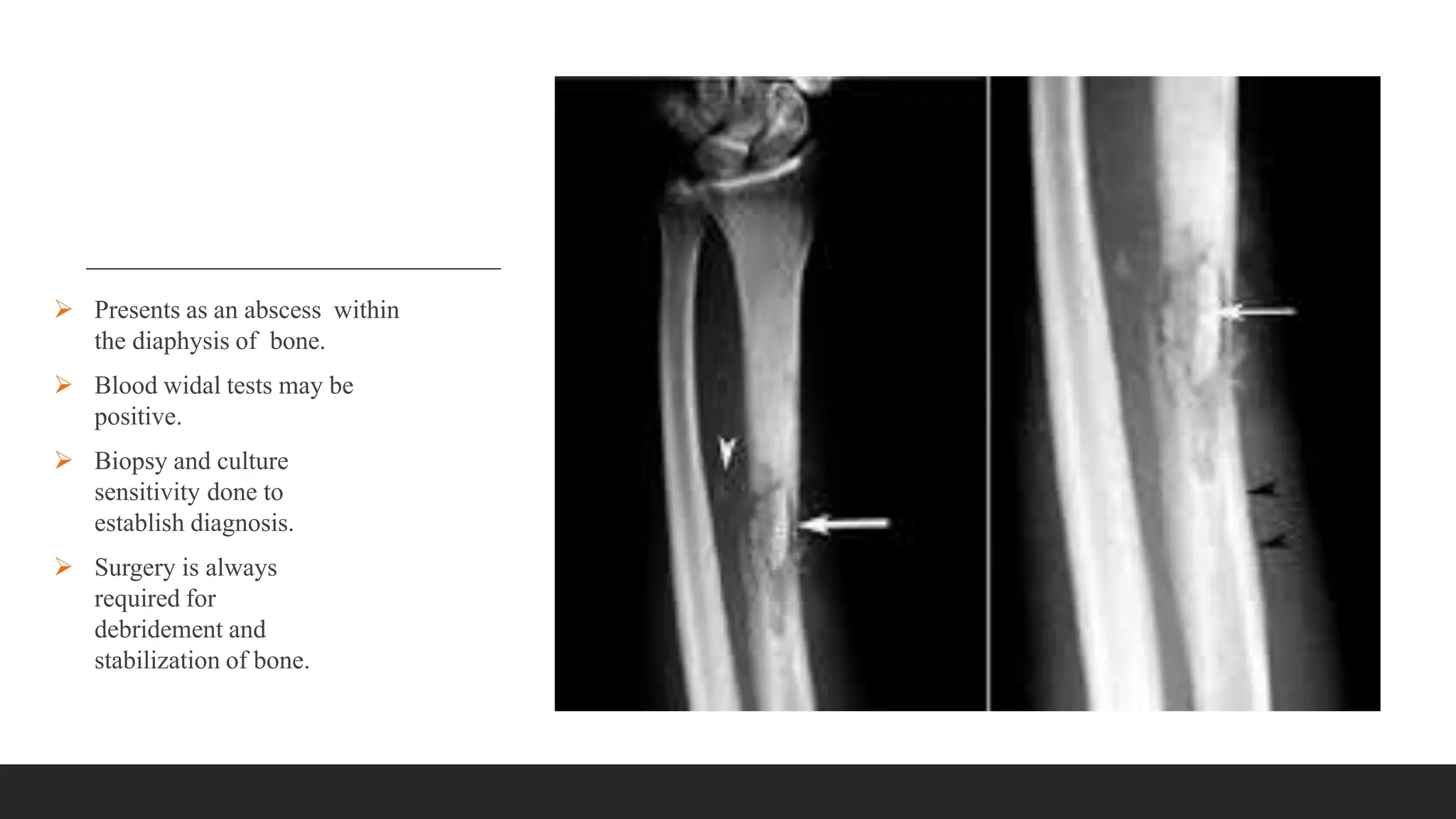 Chronic Osteomyelitis, Bone infection slides | PPTX