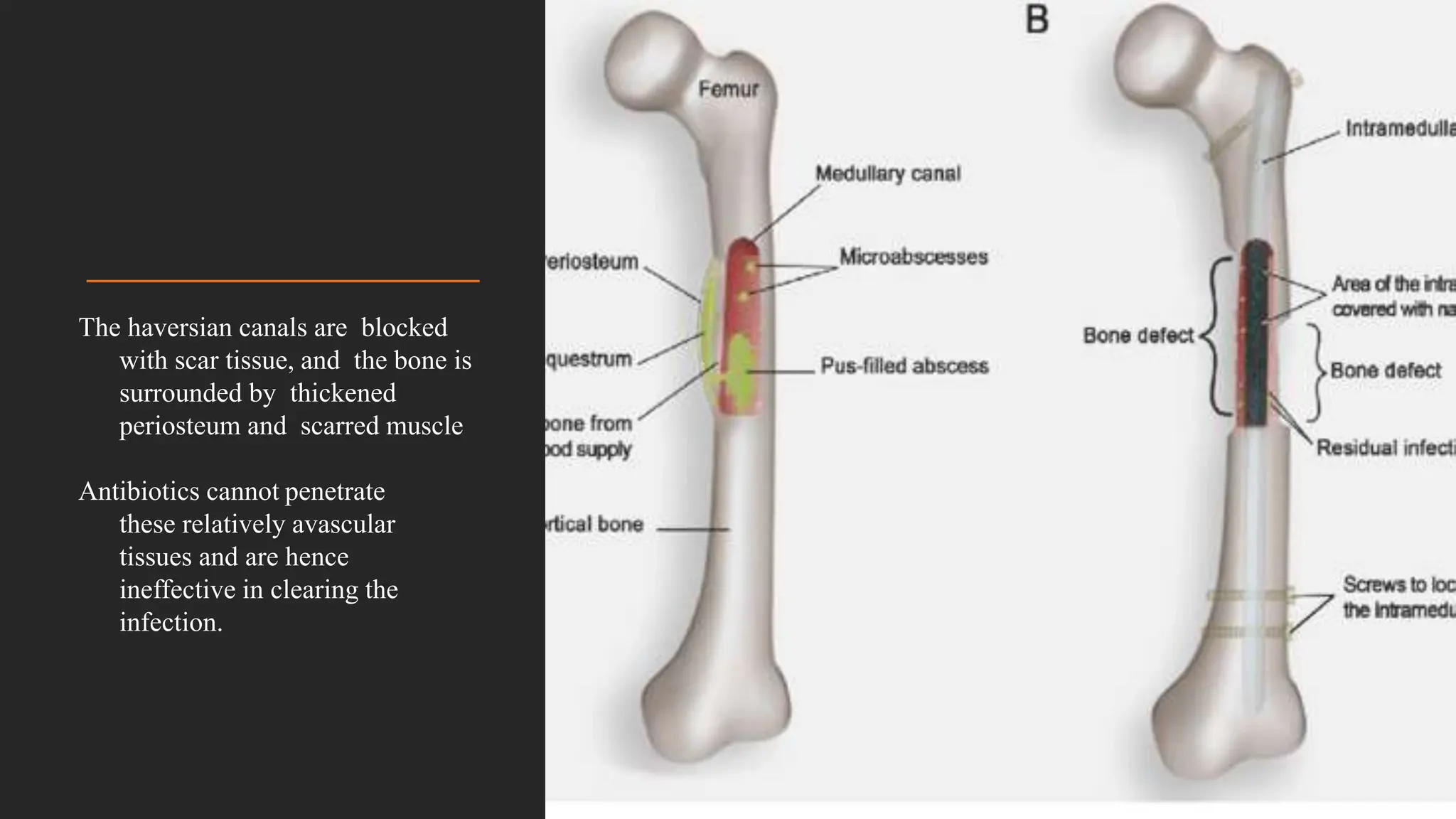 Chronic Osteomyelitis, Bone infection slides | PPTX