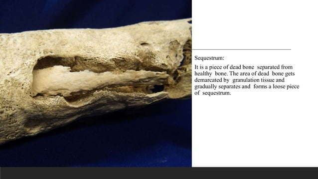 Chronic Osteomyelitis, Bone infection slides | PPTX