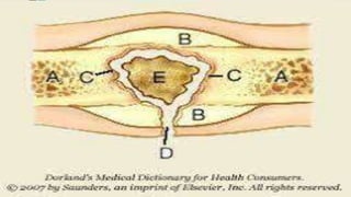 Osteomyelitis: the infection of bone and bone marrow | PPT