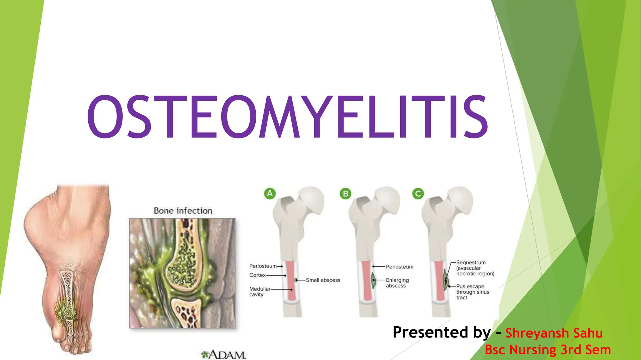 OSTEOMYELITIS PPT or SLIDE SHARE it is a bone disease | PPTX