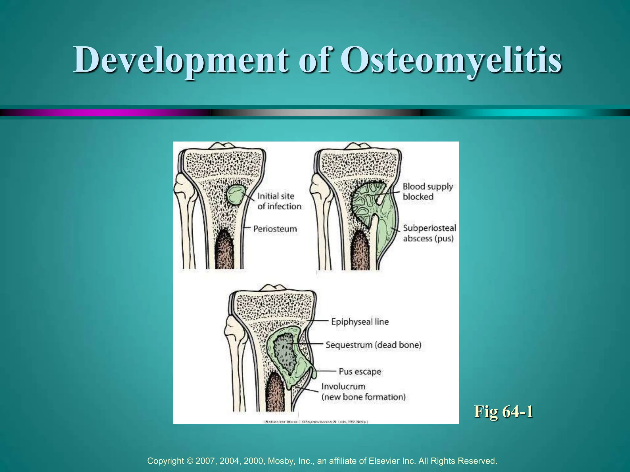 Osteomyelitis.ppt how to intervention and | PPT