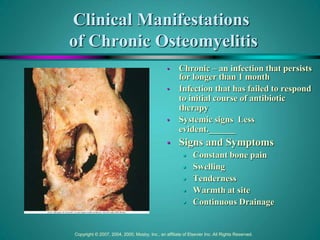 Osteomyelitis.ppt how to intervention and | PPT