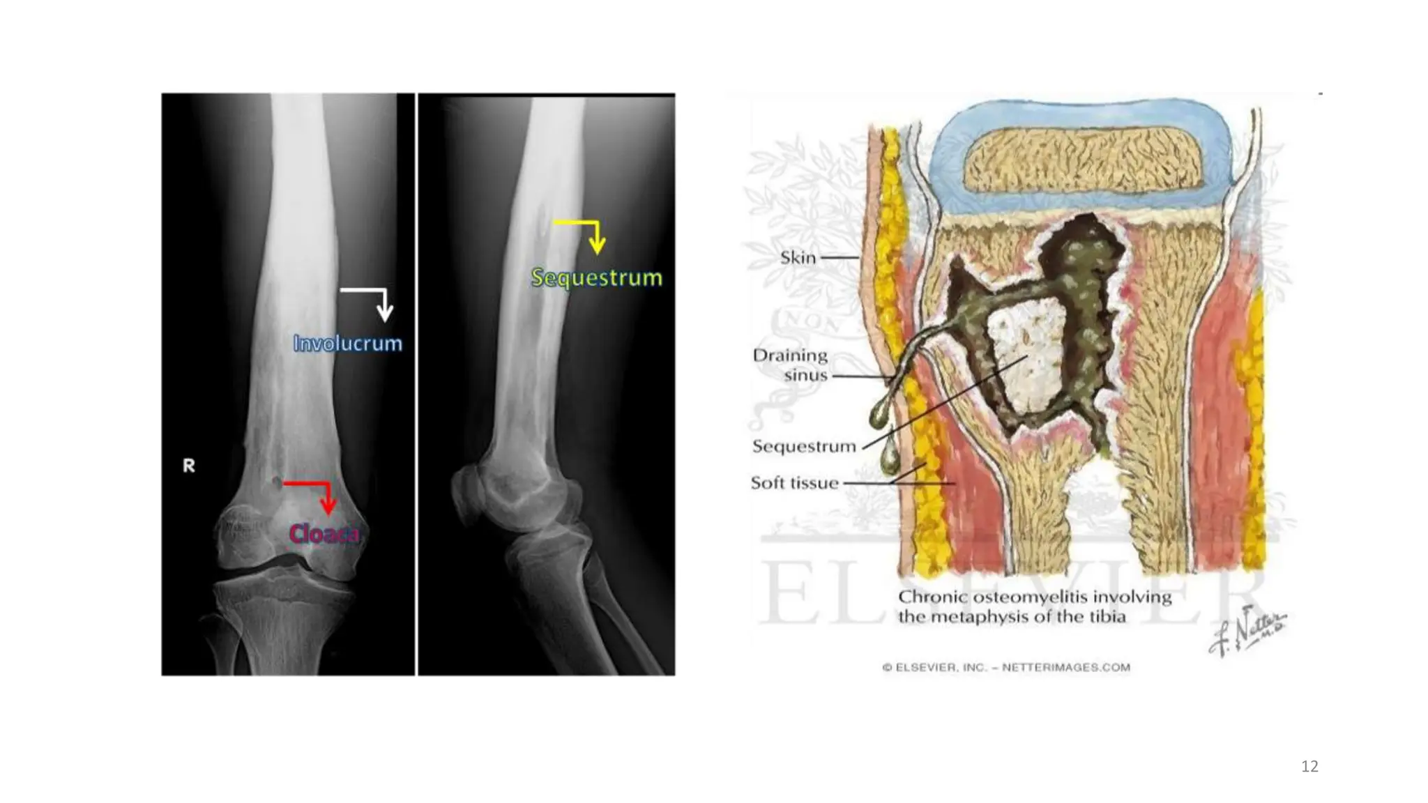 OSTEOMYELITIS - Infection of bone marrow with subsequent affection of ...