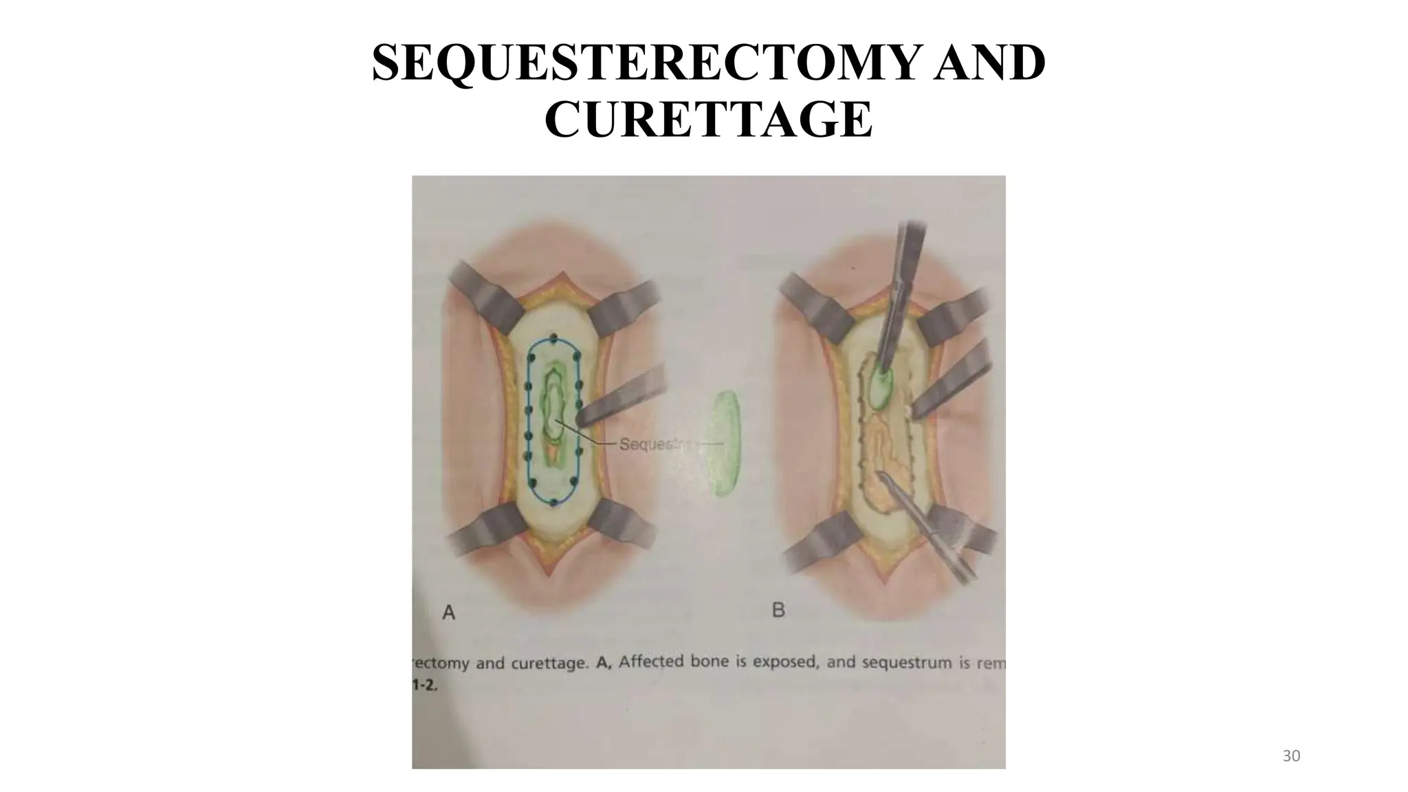 OSTEOMYELITIS - Infection of bone marrow with subsequent affection of ...