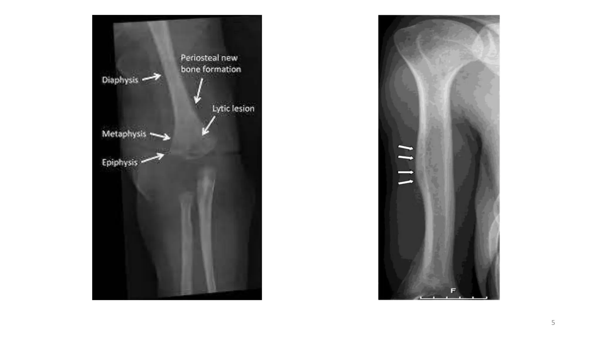OSTEOMYELITIS - Infection of bone marrow with subsequent affection of ...