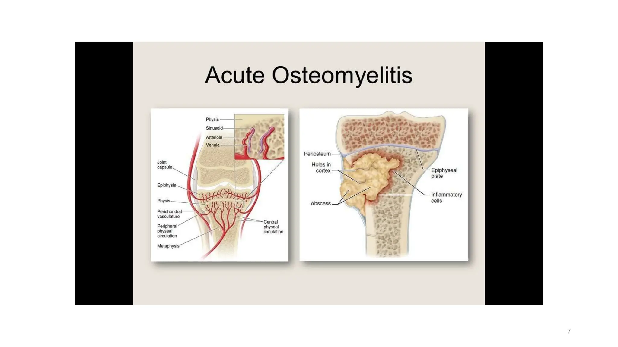 OSTEOMYELITIS - Infection of bone marrow with subsequent affection of ...