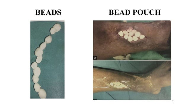 OSTEOMYELITIS - Infection of bone marrow with subsequent affection of ...