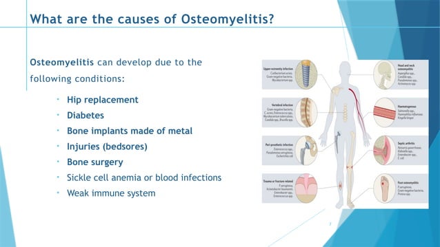 Osteomyelitis.university.presentation.pptx