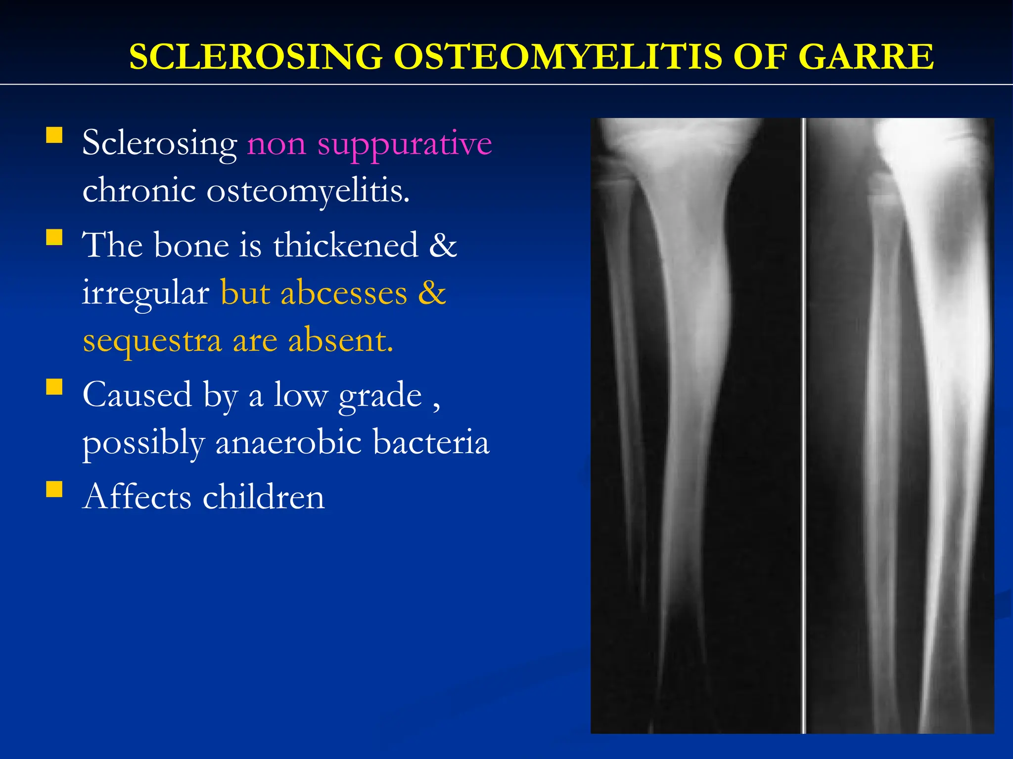 Osteomyelitis Orthopaedics academic.pptx