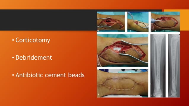 Osteomyelitis (Nutshell) | PPTX | Bone and Joint Conditions | Diseases and Conditions
