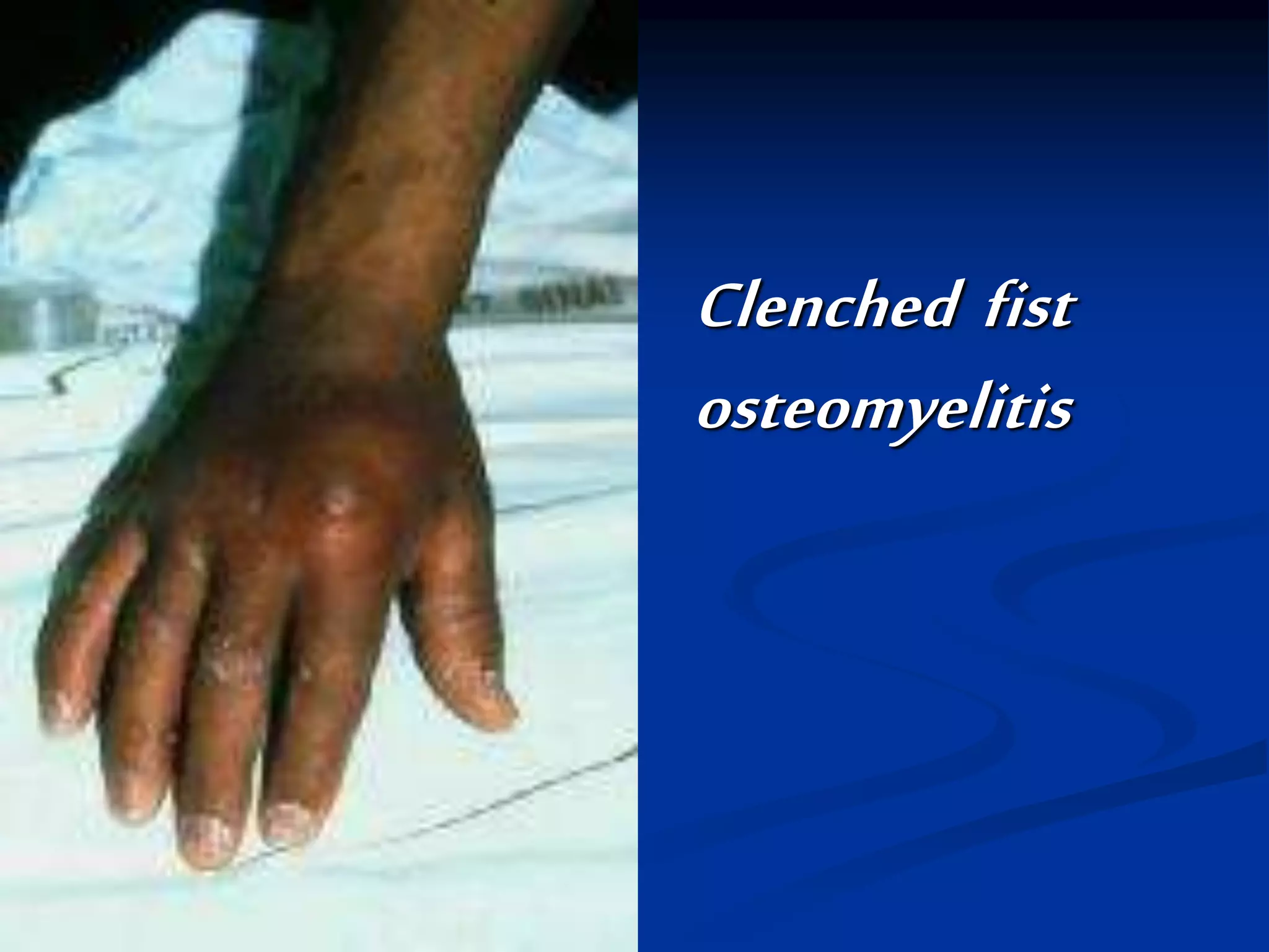 Osteomyelitis | PPT