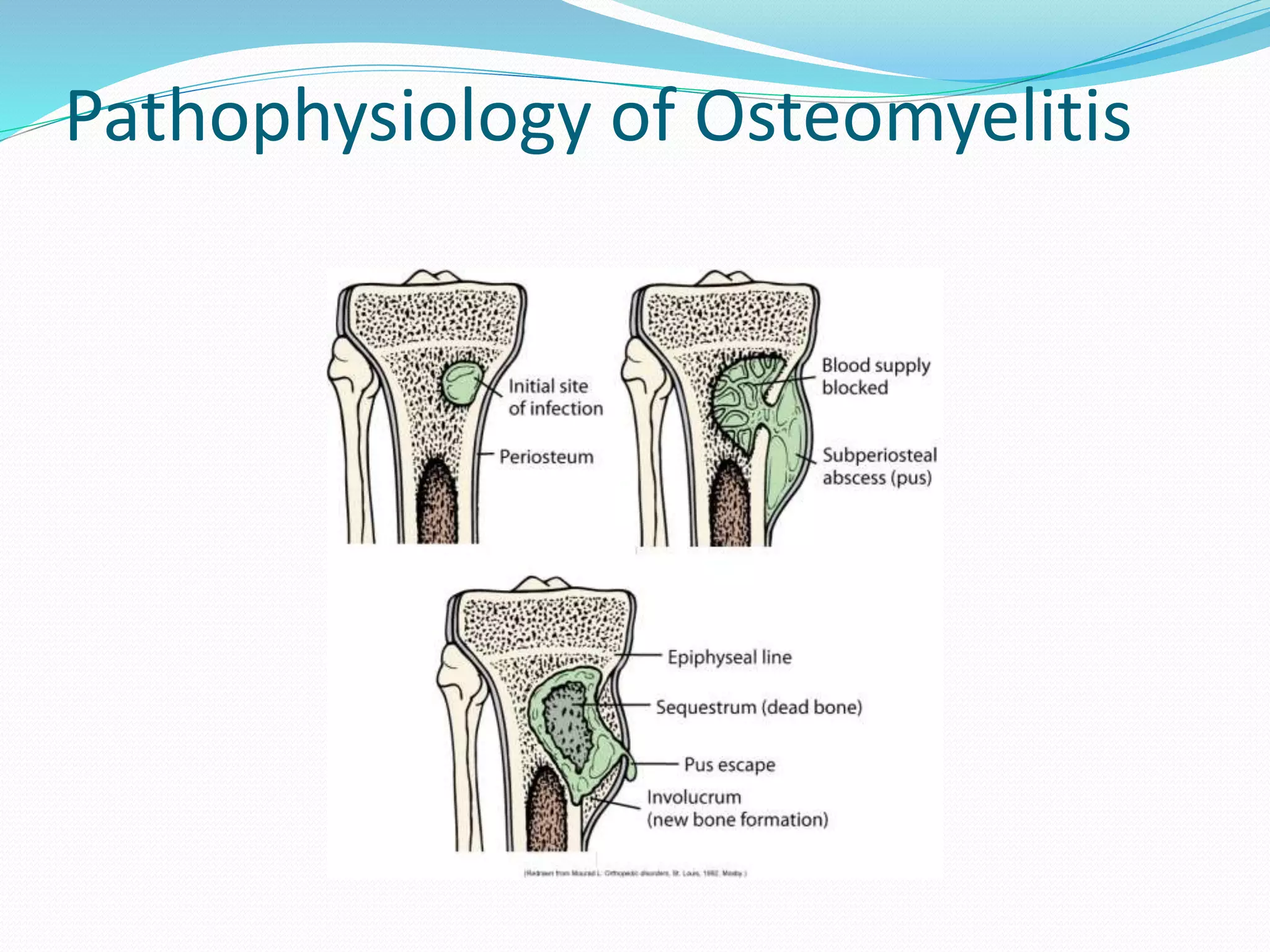 Osteomyelitis | PPTX