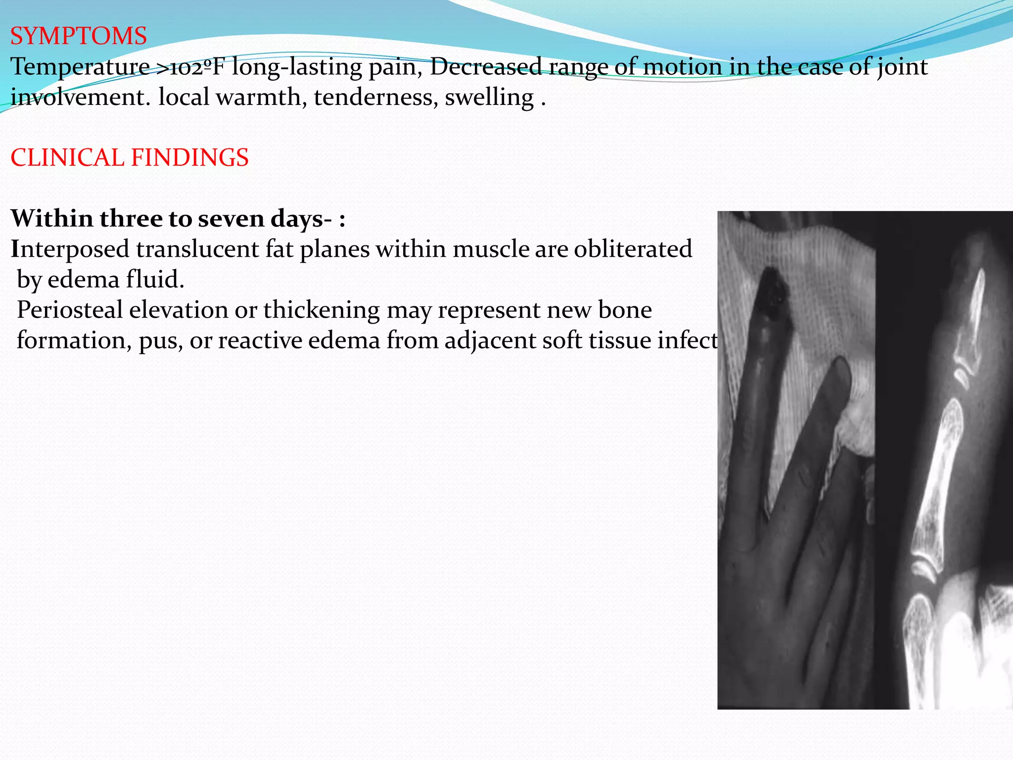 Osteomyelitis | PPTX