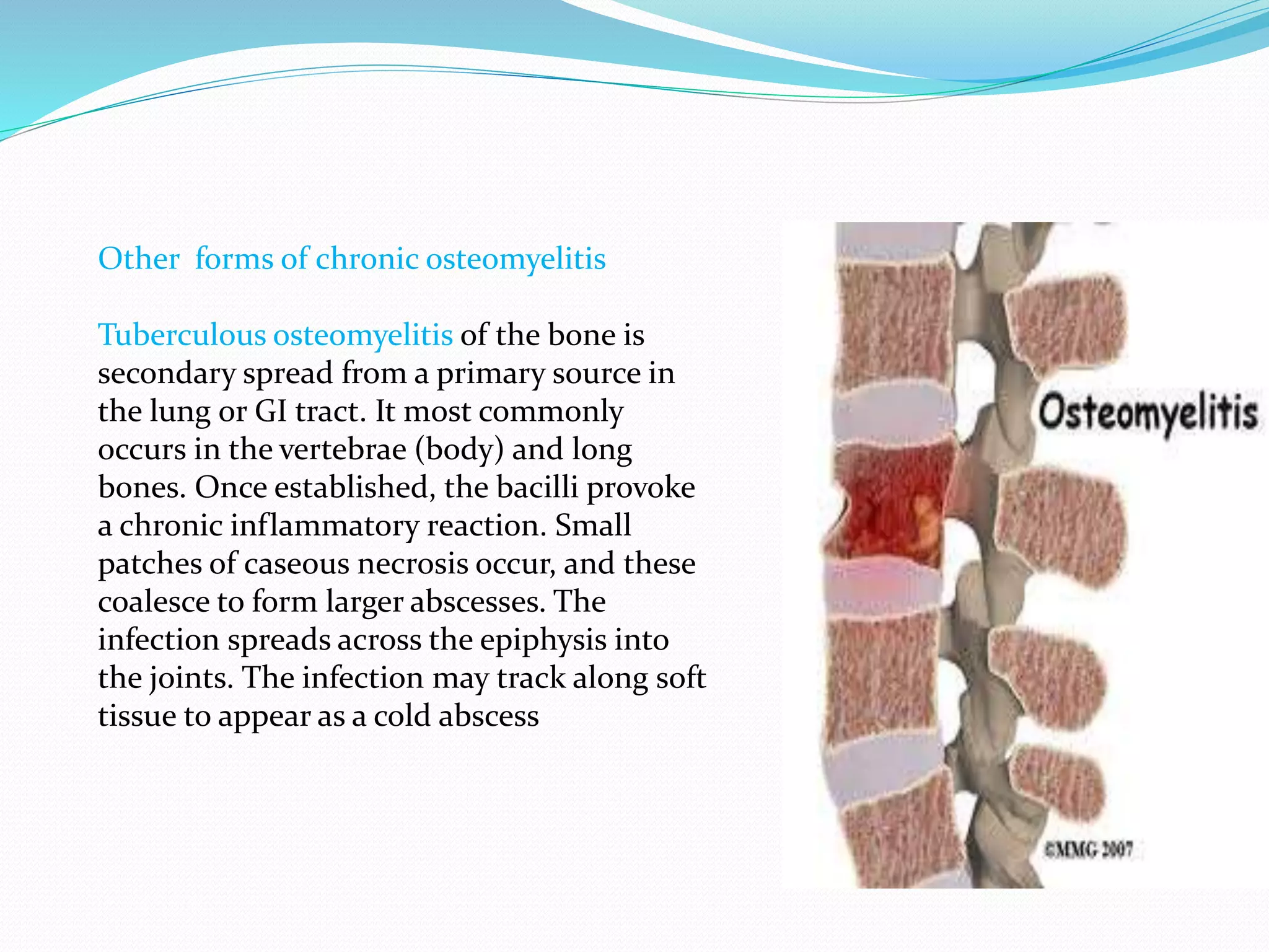 Osteomyelitis | PPTX