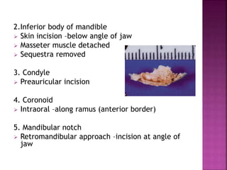 Osteomyelitis of jaws | PPTX
