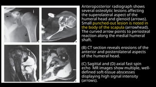 osteomyelitis and infections arthritis ,soft tissue .pptx