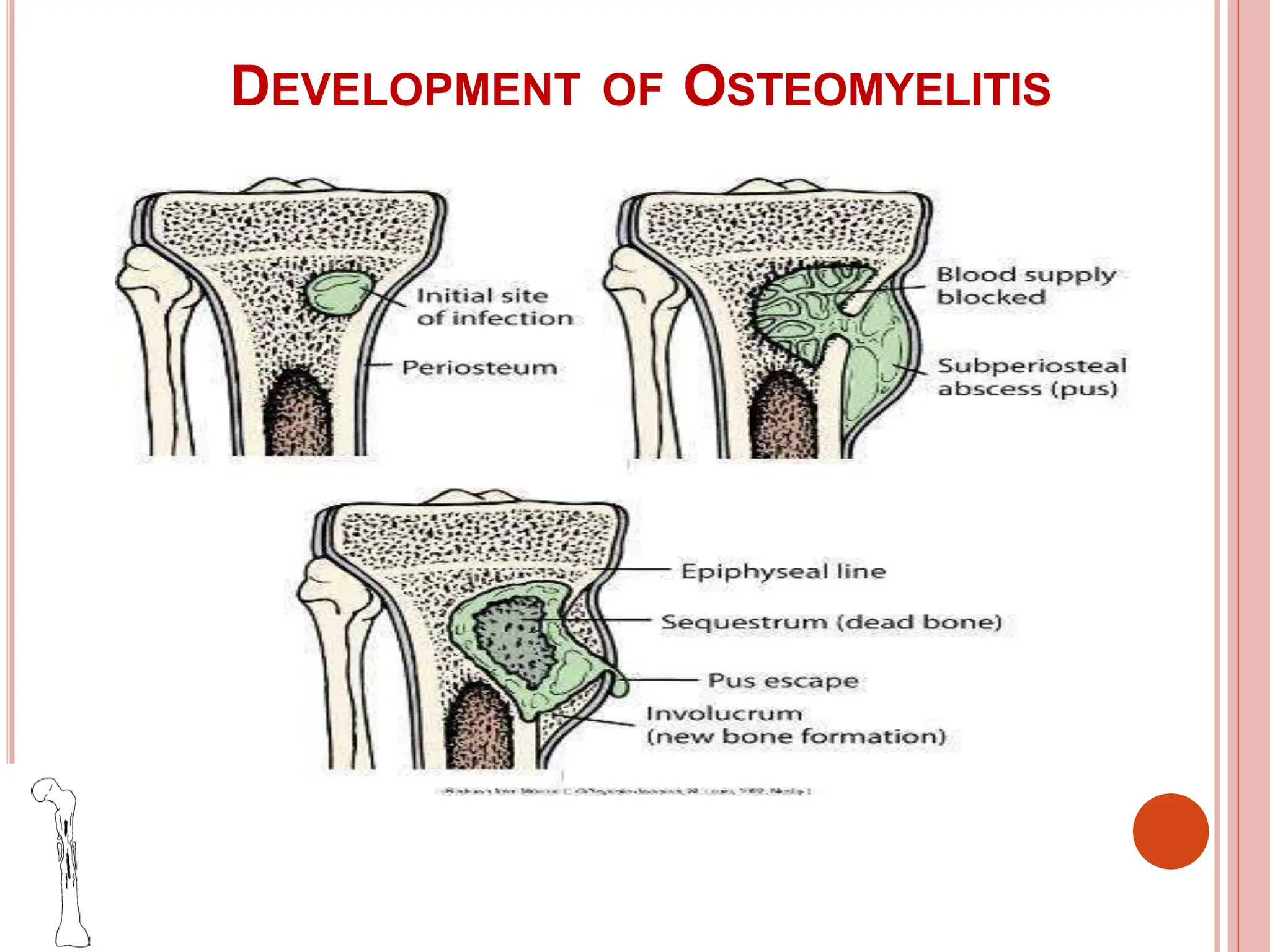osteomyelitis-Types, clinic features and treatment.pptx