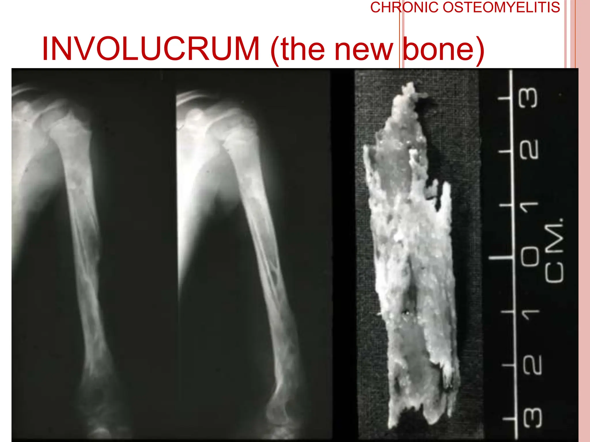 osteomyelitis-Types, clinic features and treatment.pptx | Bone and ...