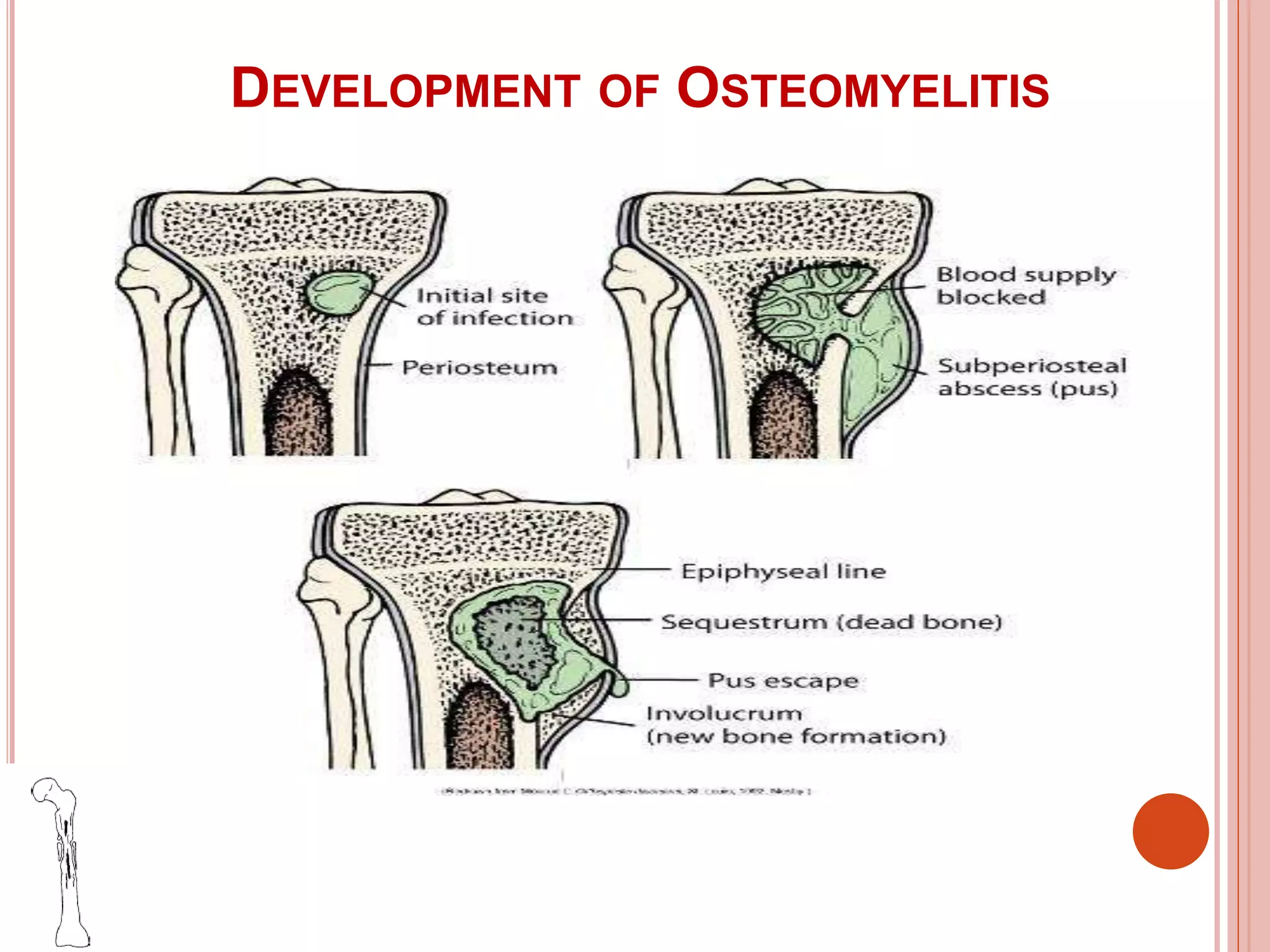 Osteomyelitis | PPTX